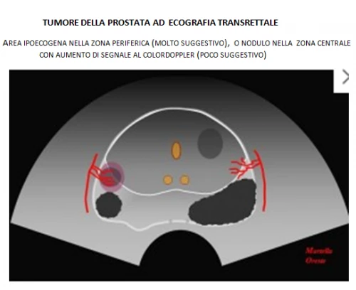Ecografia transrettale a Lecce e provincia : (Casarano)